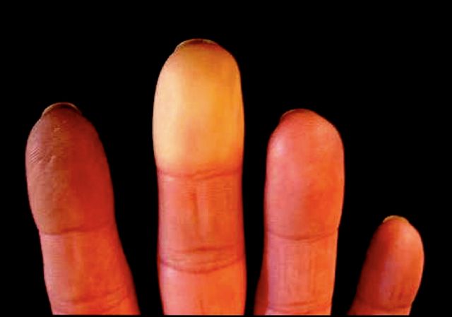 Il 29 giugno 2013 si celebra la terza giornata mondiale della sclerodermia